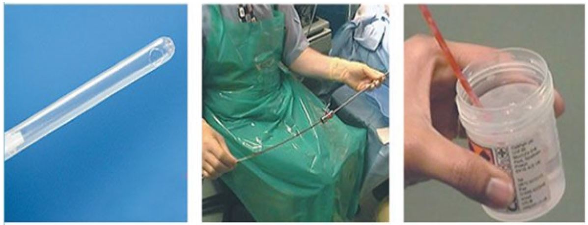 H Pipelle: New device for endometrial sampling – Hysteroscopy Newsletter