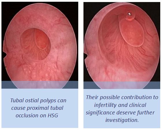 Tubal Ostial Polyp – Hysteroscopy Newsletter