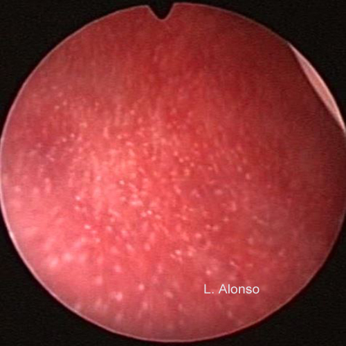 ENDOMETRIAL CYCLE & Hysteroscopy – Hysteroscopy Newsletter