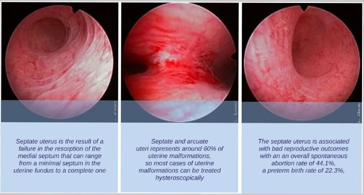 Hysteroscopy Pictures: Uterine septum – Hysteroscopy Newsletter