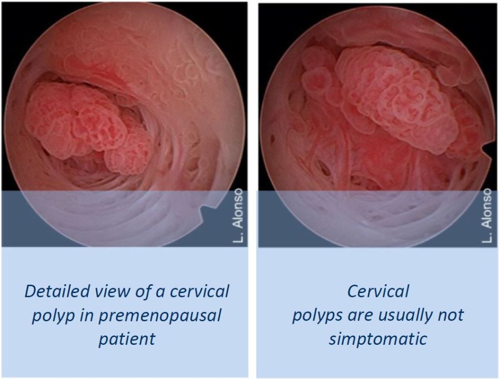 Cervical Polyp – Hysteroscopy Newsletter