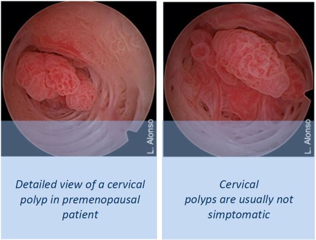 Cervical Polyps