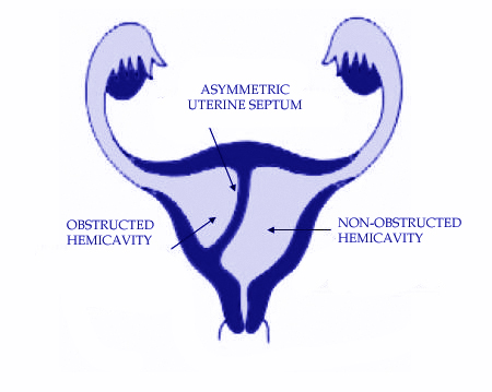 Robert’s Uterus – Hysteroscopy Newsletter